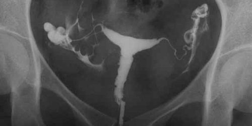 Vous allez avoir une hystérographie – Normedis Radiologie